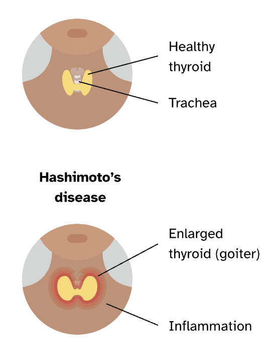 Hashimoto’s Disease: Genetics and More - 23andMe